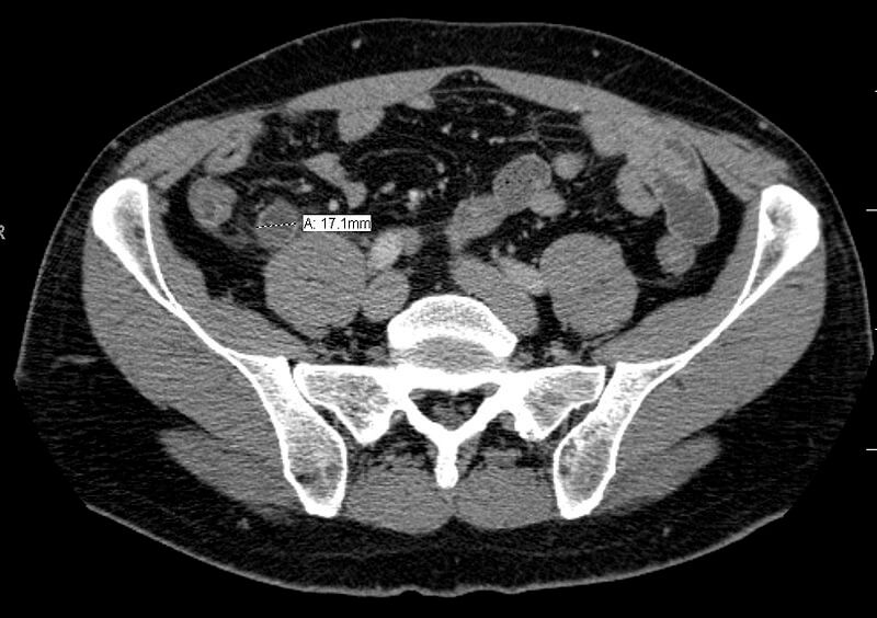 Your Appendix May Not Be Useless After All