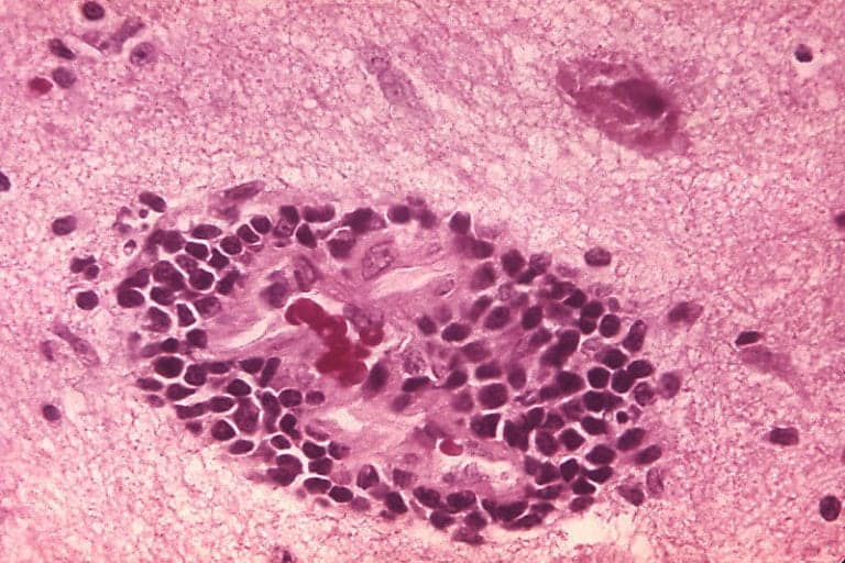 Scientists Mimic Deadly Rabies Virus to Destroy Brain Cancer Cells