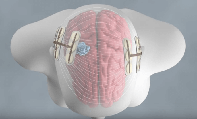 Cancer-Fighting Cap Nearly Doubles the Survival Rate for Brain Cancer
